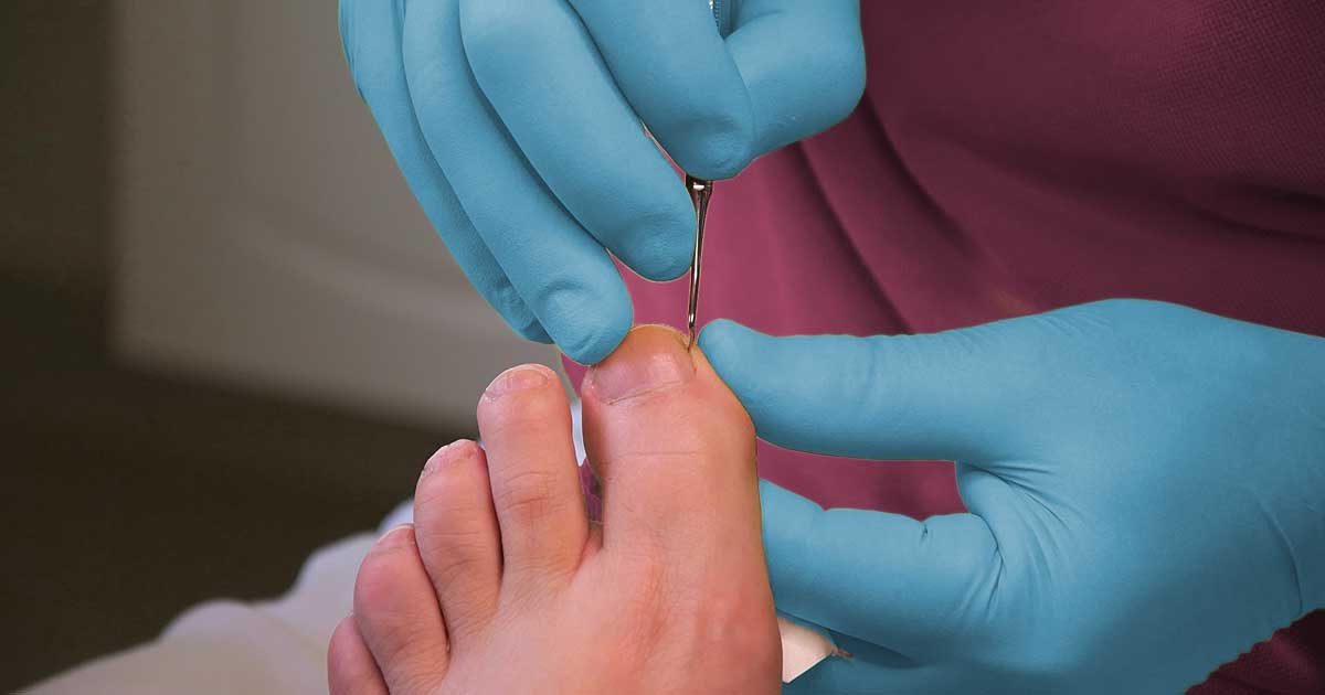 Why correct toenail cutting is important and how to do it. - TheFootNurse
